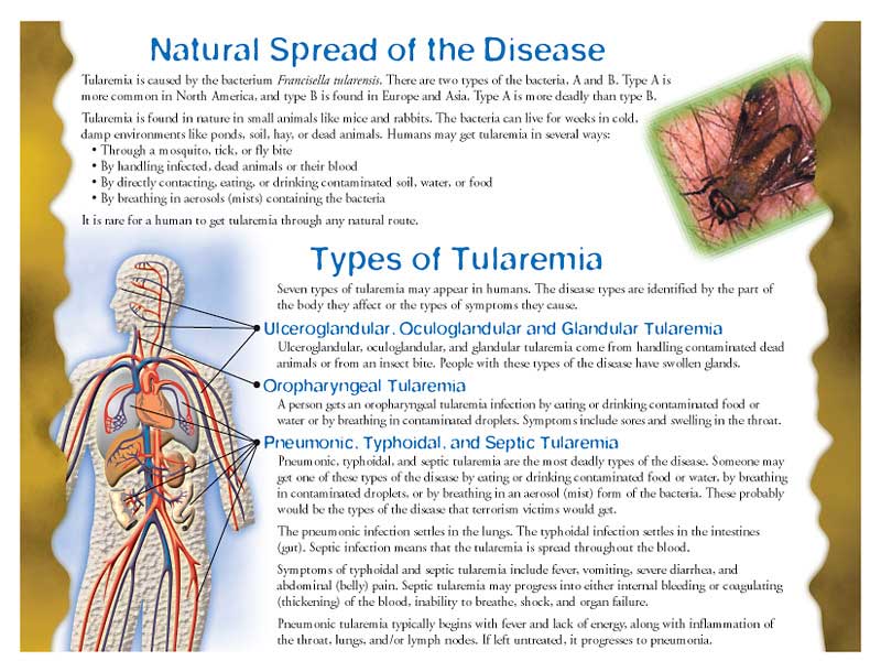 Pneumonic Tularemia